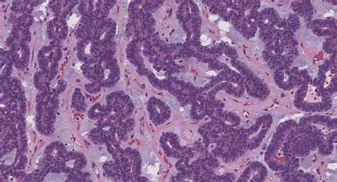 Canalicular Adenoma Ottawa Atlas Of Pathology