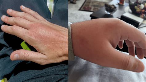 Swollen Bug Bites