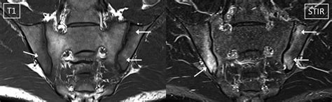 Defining Active Sacroiliitis On Mri For Classification Of Axial