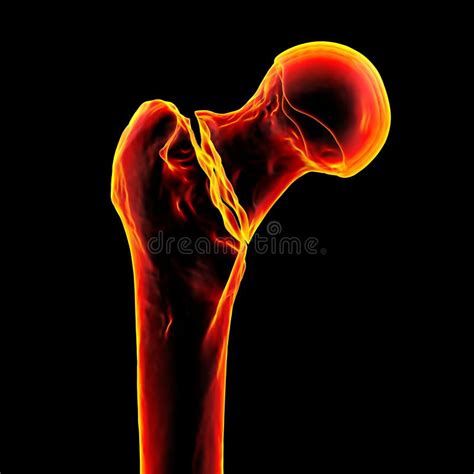 Basicervical Femur Fracture 3d Illustration Stock Illustration
