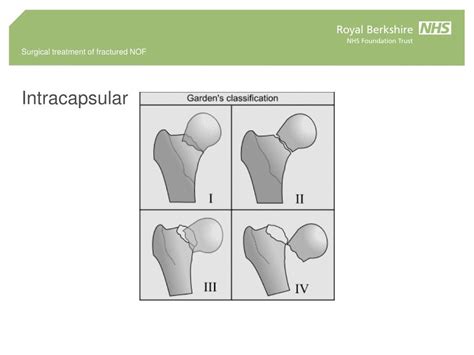 Ppt Comprehensive Surgical Treatment Of Fractured Hip Neck Of Femur Nof Powerpoint