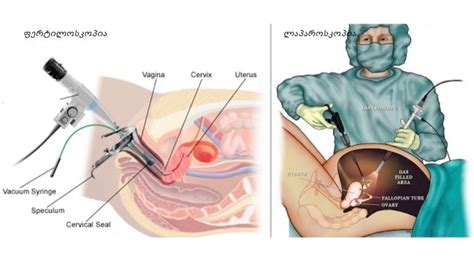რომელი მეთოდი უფრო ეფექტურია უშვილობის დიაგნოსტიკასა და მკურნალობაში ფერტილოსკოპია თუ