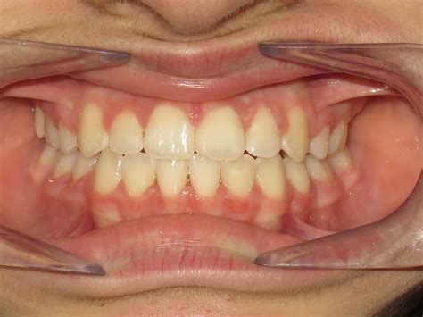 Crookedovercrowded Teeth Teeth In Line