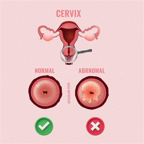 Pregnancy 👩‍⚕️ Normal Vs Abnormal Cervix What To Know Normal Cervix 🔹 Smooth Surface 🔹