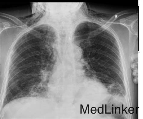 食管异物一例 医联