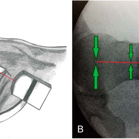 Pdf A Simple Method For Measurement Of Femoral Anteversion Validation And Assessment Of