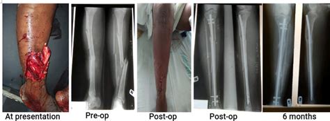 Photographs Of A 51 Year Old Woman Who Sustained Type IIIA Tibia Download Scientific Diagram