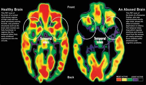 The Impact Of Neglect On The Developing Brain Simply Fostering