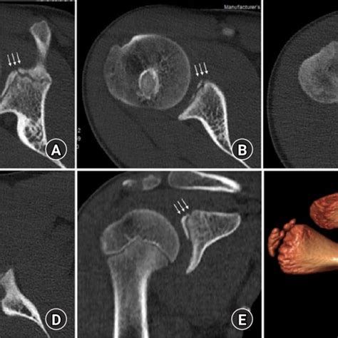 Pdf Normal Ossification Of The Glenoid Mimicking A Glenoid Fracture In An Adolescent Patient