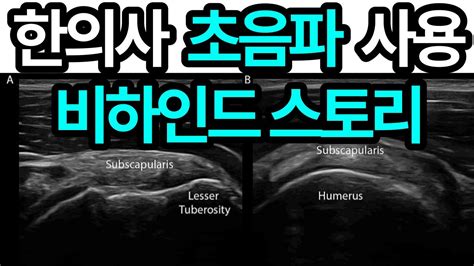 한의사 초음파 기기 사용 이게 왜 진짜 Youtube