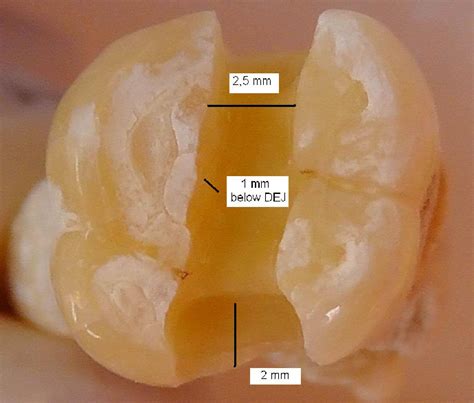 Figure 1 From Microleakage In Combined Amalgamcomposite Resin Restorations In Mod Cavities