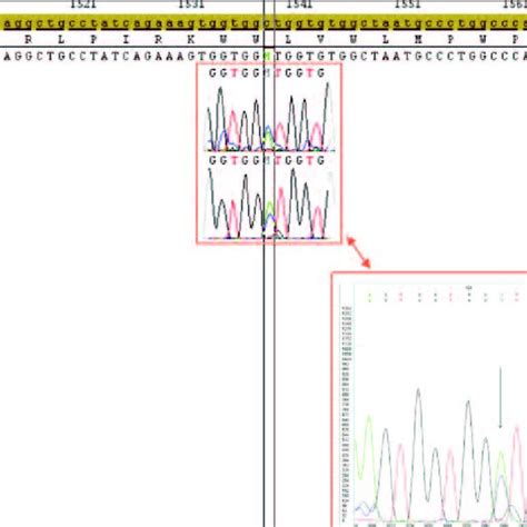 Beta Globin Gene Sequence Analysis Result The Indicated Area Shows The