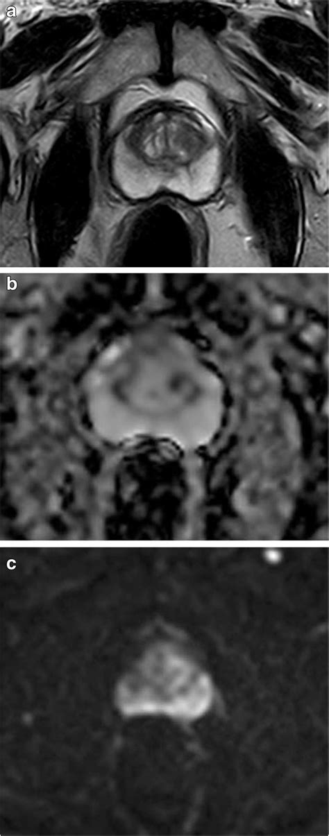 Pi Rads Ii Benign Prostatic Hyperplasia A Axial T2 Wi Shows Tz Download Scientific Diagram