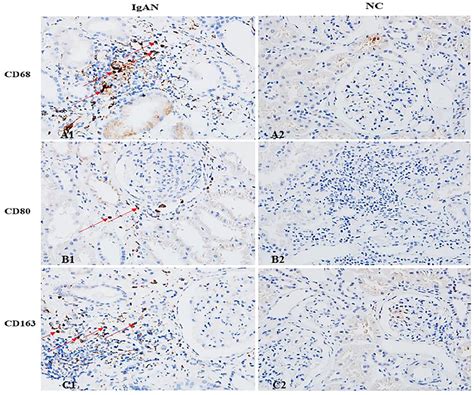 Frontiers The Role of Renal Macrophage AIM and TGF β Expression in Renal Fibrosis
