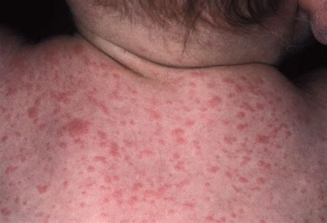 Roseola Rash Medical Point