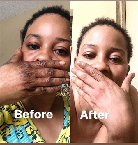 Dark Knuckles Remover Set