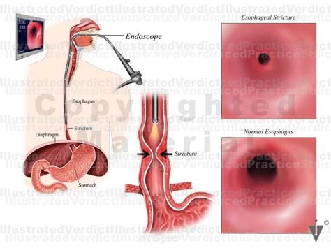 Stock Upper Gi Endoscope — Illustrated Verdict