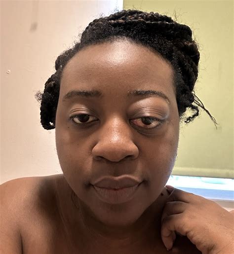 ‘doctors Told Me It Was A Simple Stye Then My Eye Was Bulging Out Of