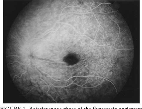 Cystoid Macular Edema Fluorescein Angiography