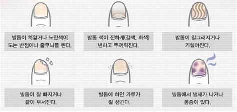 내 발톱에 무좀이 생겼어요 손발톱 무좀