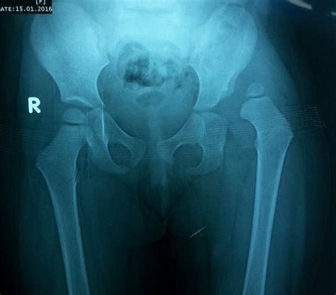 Female Patient 2 6ys Old With Pre Operative Acetabular Index Is 50 O Download Scientific Diagram