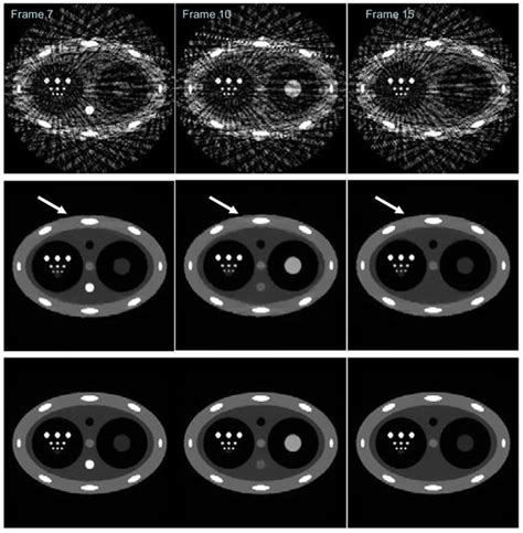 Prior Image Constrained Compressed Sensing Piccs Pmc