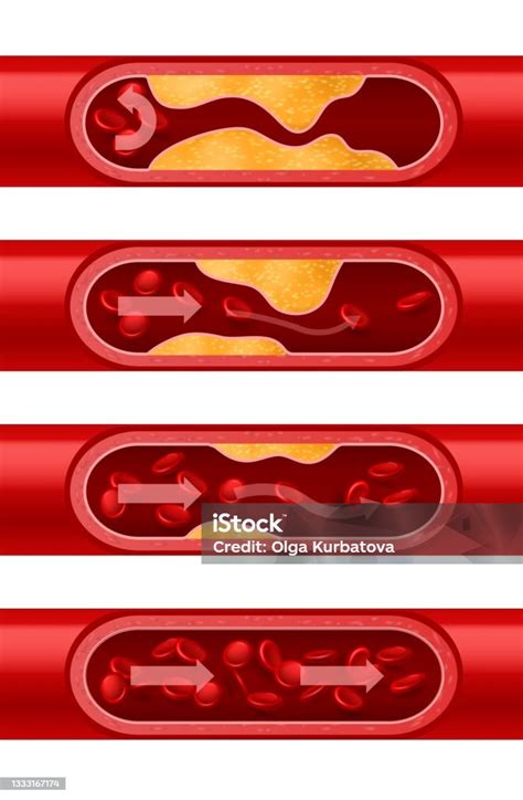 Arteri Aterosklerosis Tiridemilangkah Pengendapan Kolesterol Dinding Arteri Set Bagian Pembuluh