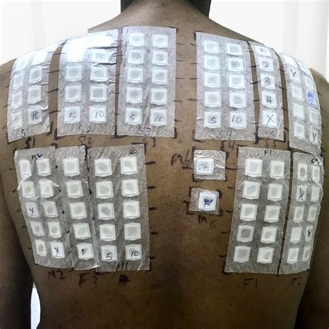 Patch Testing Nova Medical Center