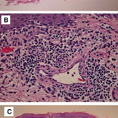 A Follicular Plugging And Perivascular Lymphocytic Infiltration Download Scientific Diagram