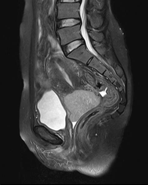 Radiodiagnosis Imaging Is Amazing Interesting Cases Cervical Carcinoma Mri