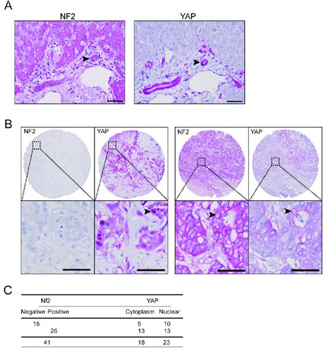 Ihc Staining For Nf2 And Yap In Human Icca A And B Representative Download Scientific