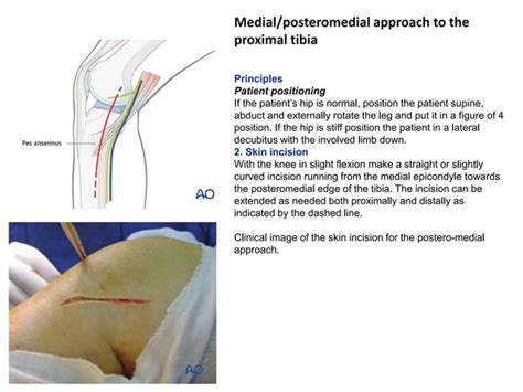 Proximal Tibia Approachpptx