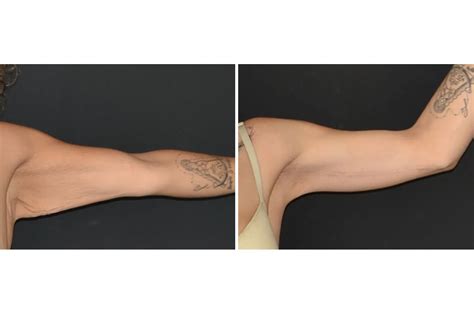 Brachioplasty Imagn Institute