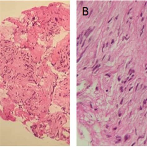 A Histological Appearance Of A Gastric Gist In A 66 Year Old Patient Download Scientific