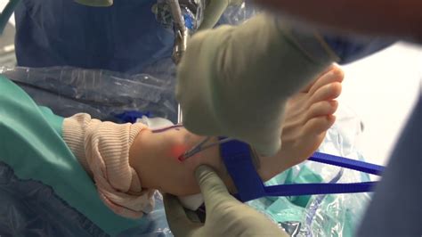 Ankle Arthroscopy And Microfracture Youtube