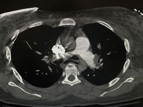 Yahya Al Asiri On Linkedin Pe Thrombectomy Is A Valuable Service In Our Ir Department Those Are…