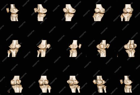 Premium Photo Collection Of Xray Humans Knee Joints Finding Fracture Proximal Metaphysis Of Tibia