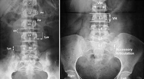 Transitional Lumbosacral Anatomy Explore Organs And Anatomy Diagram