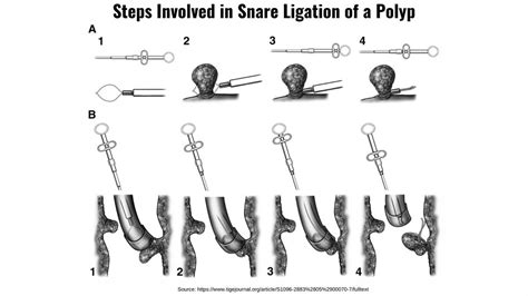 Endocollab™ Gastroenterology And Endoscopy Education On Linkedin Steps