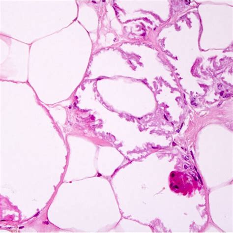 Clinical Features Evaluation And Management Of Lipodermatosclerosis And Chronic Venous Disease