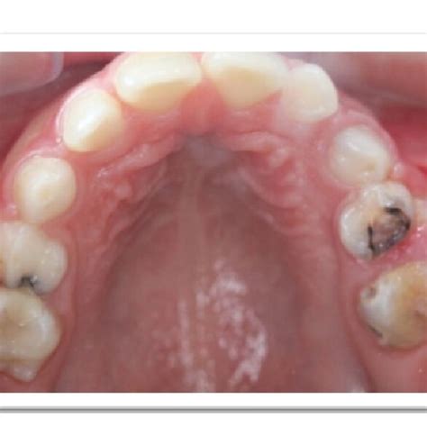 Maxillary Occlusal Aspect Of The Patient 1 Download Scientific Diagram
