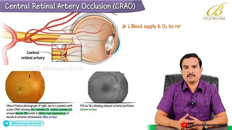 Central Retinal Artery Occlusion Crao 👁️ Internal Medicine