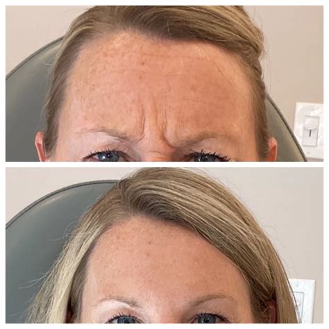 Everything You Need To Know About Forehead Botox For Wrinkles