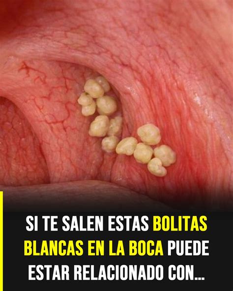 Parejas ¿sabías Que Si Te Salen Estas Bolitas Blancas En Facebook