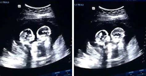 10 Week Ultrasound Identical Twins
