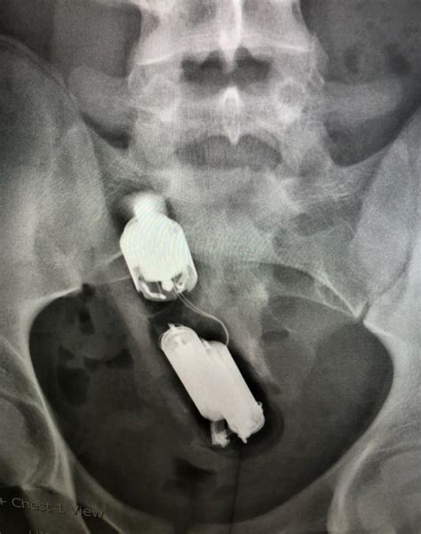 Don T Know How That Got In There Doc R Radiology