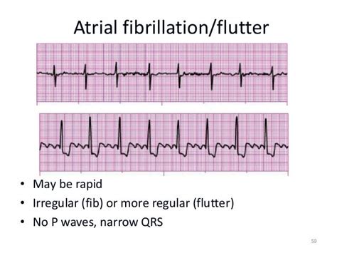Atrial Flutter Vs Afib Hourhac