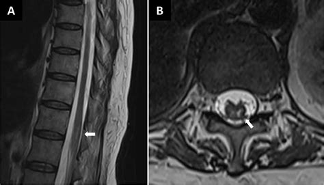 Isolated Infarctions Of The Conus Medullaris Clinical Features And