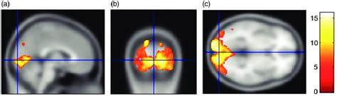 Usual Activation Of The Visual Cortex In Control Subject No Download Scientific Diagram
