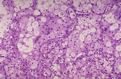 Cryptococcus Histology